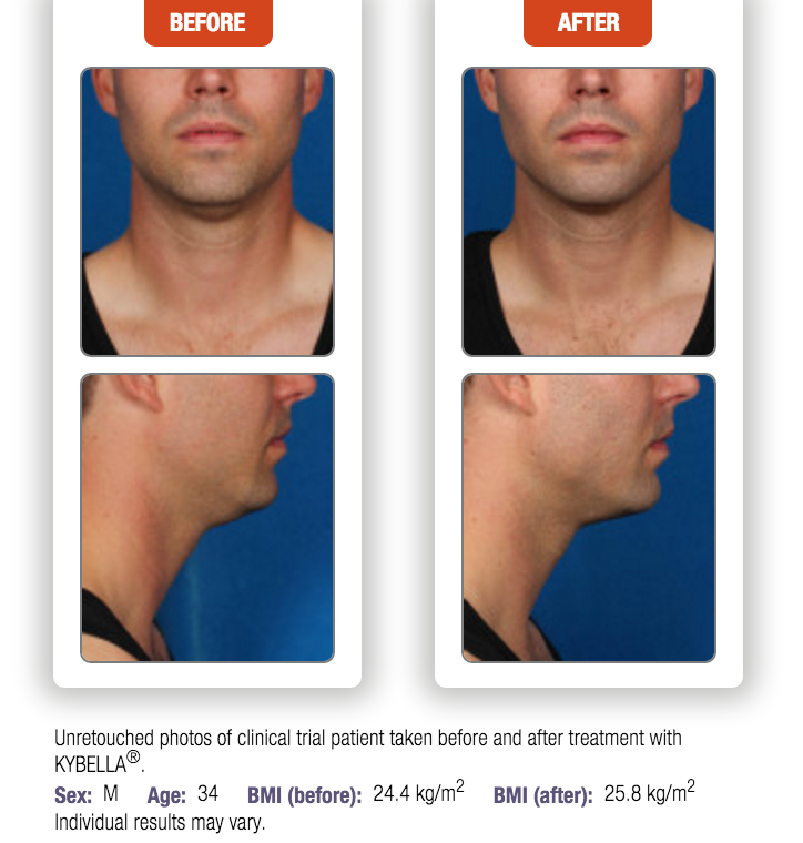 Submental Fat Reduction - Kybella - Danyo Plastic Surgery