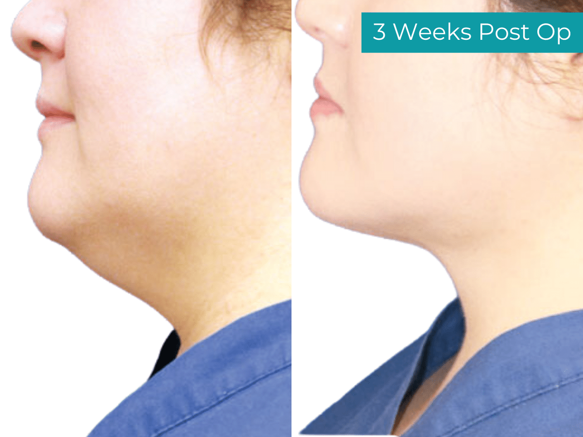 Renuvion - Danyo Plastic Surgery