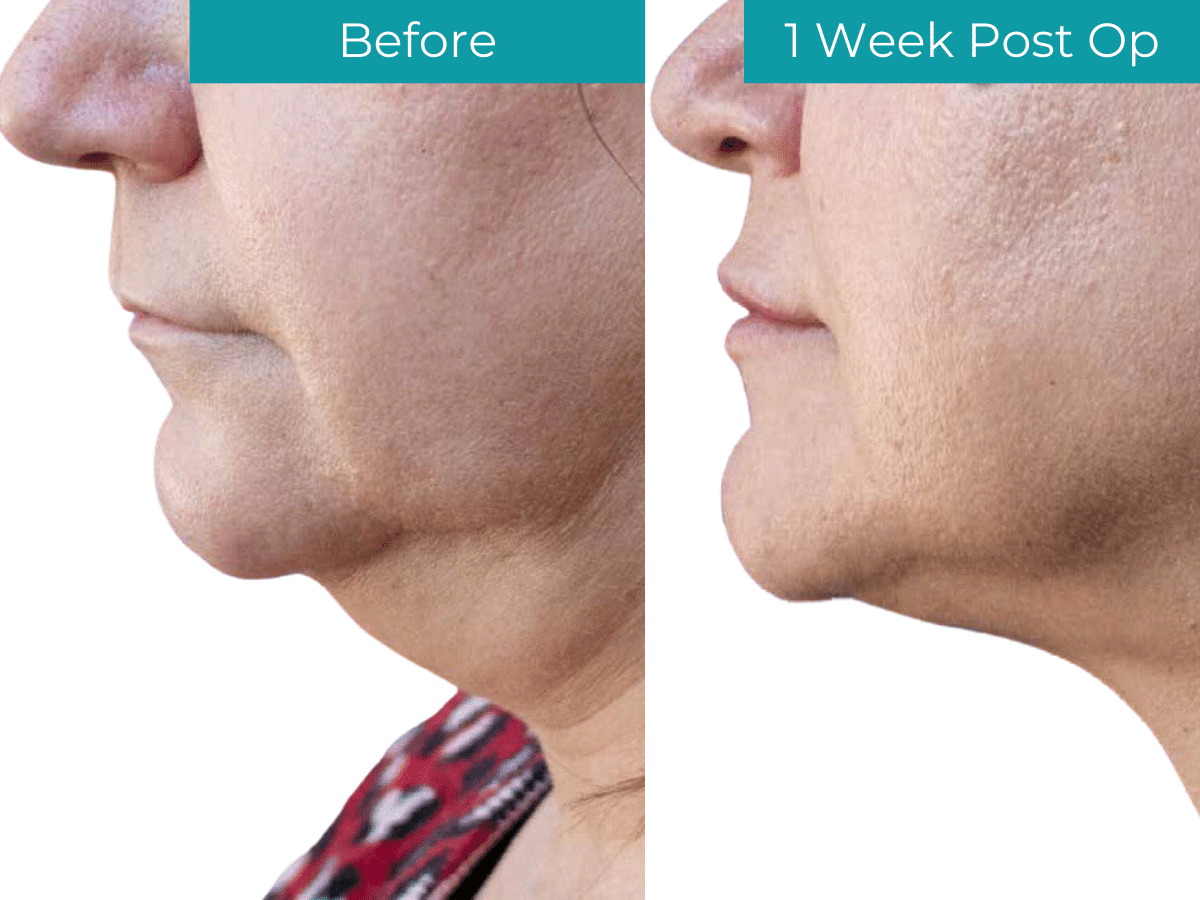 Renuvion - Danyo Plastic Surgery